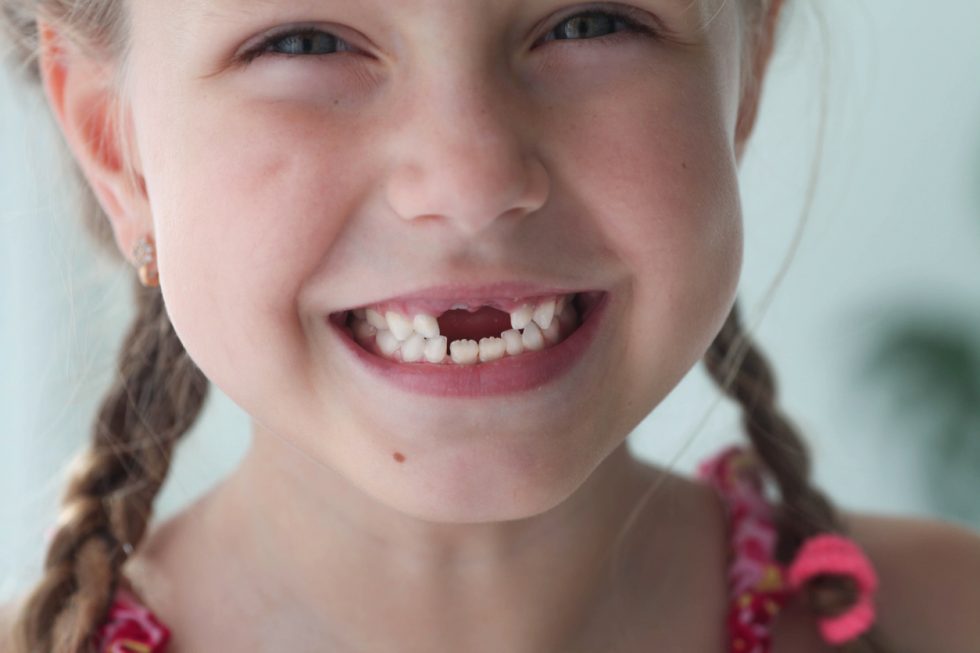 Mind The Gap: Options for Replacing a Missing Tooth | SMILE! Advanced ...